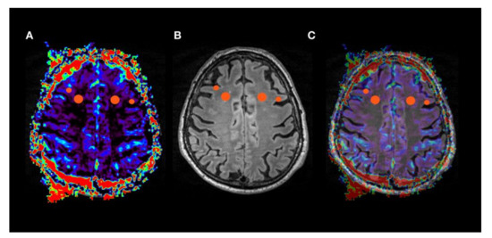 DSC Brain Perfusion Using Advanced Deconvolution Models in the ...