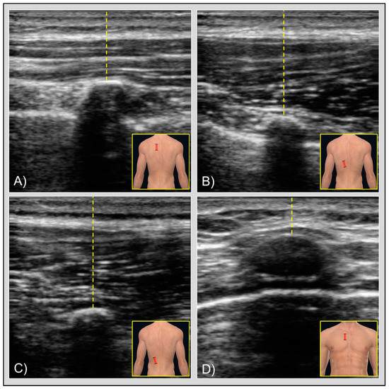 Enhancing Trigger Point Dry Needling Safety by Ultrasound Skin-to-Rib ...