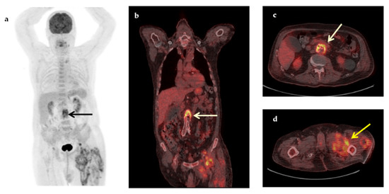 Diagnostic Value of 18F-FDG-PET/CT in Patients with FUO