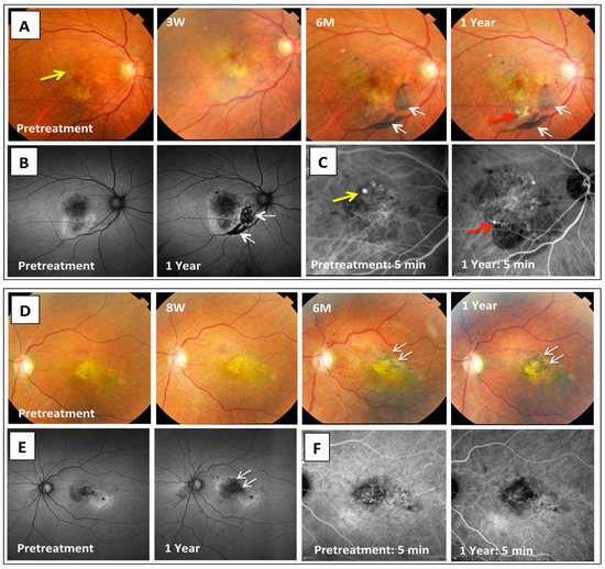 HLA-Matched Allogeneic iPS Cells-Derived RPE Transplantation for ...