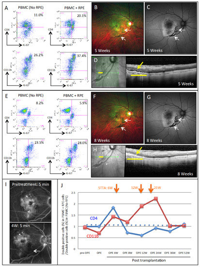 HLA-Matched Allogeneic iPS Cells-Derived RPE Transplantation for ...