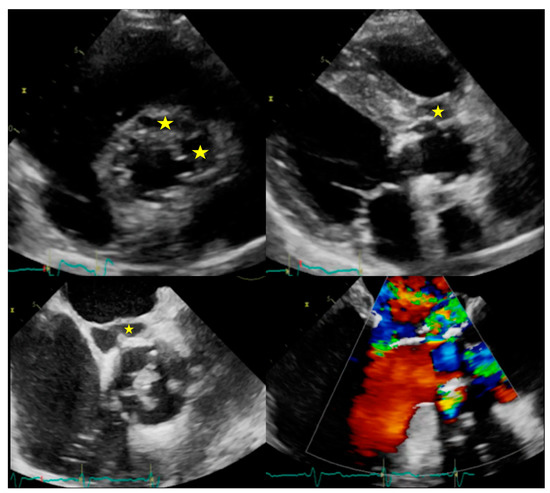 Multimodality Imaging in the Diagnostic Work-Up of Endocarditis and ...