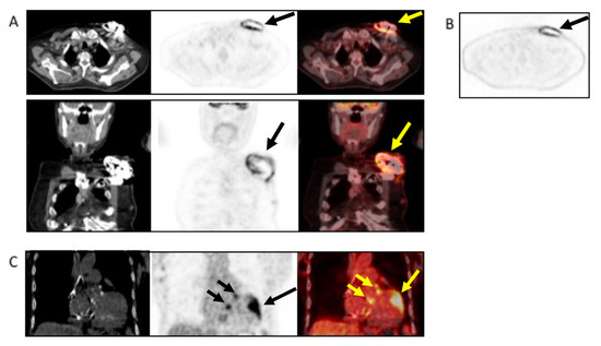 Multimodality Imaging in the Diagnostic Work-Up of Endocarditis and ...