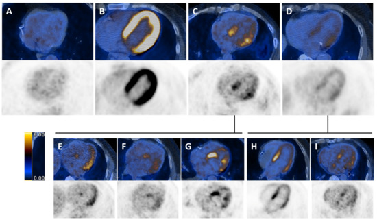 Myocardial 18F-FDG Uptake Pattern for Cardiovascular Risk ...