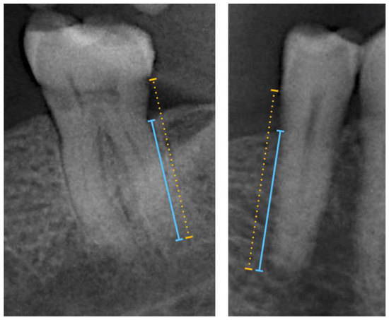 Severe Periodontitis Radiograph