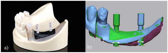 How Accurate Is Oral Implant Installation Using Surgical Guides Printed ...
