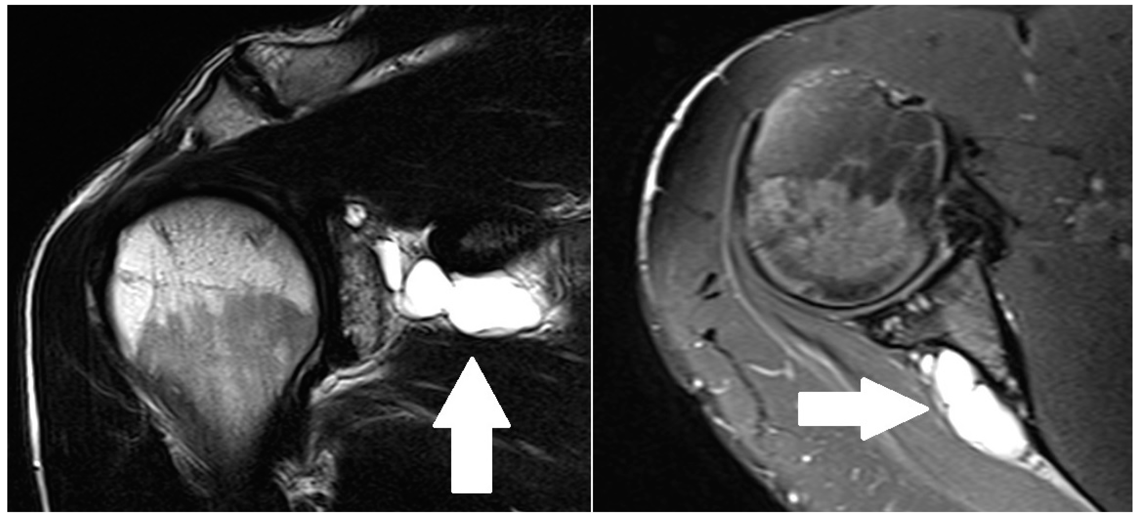 Suprascapular Notch Mri
