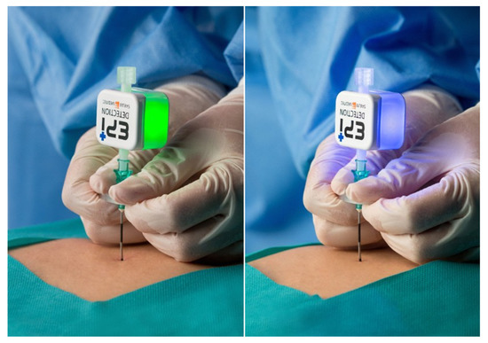Feasibility of Using the Epidural Space Detecting Device (EPI ...