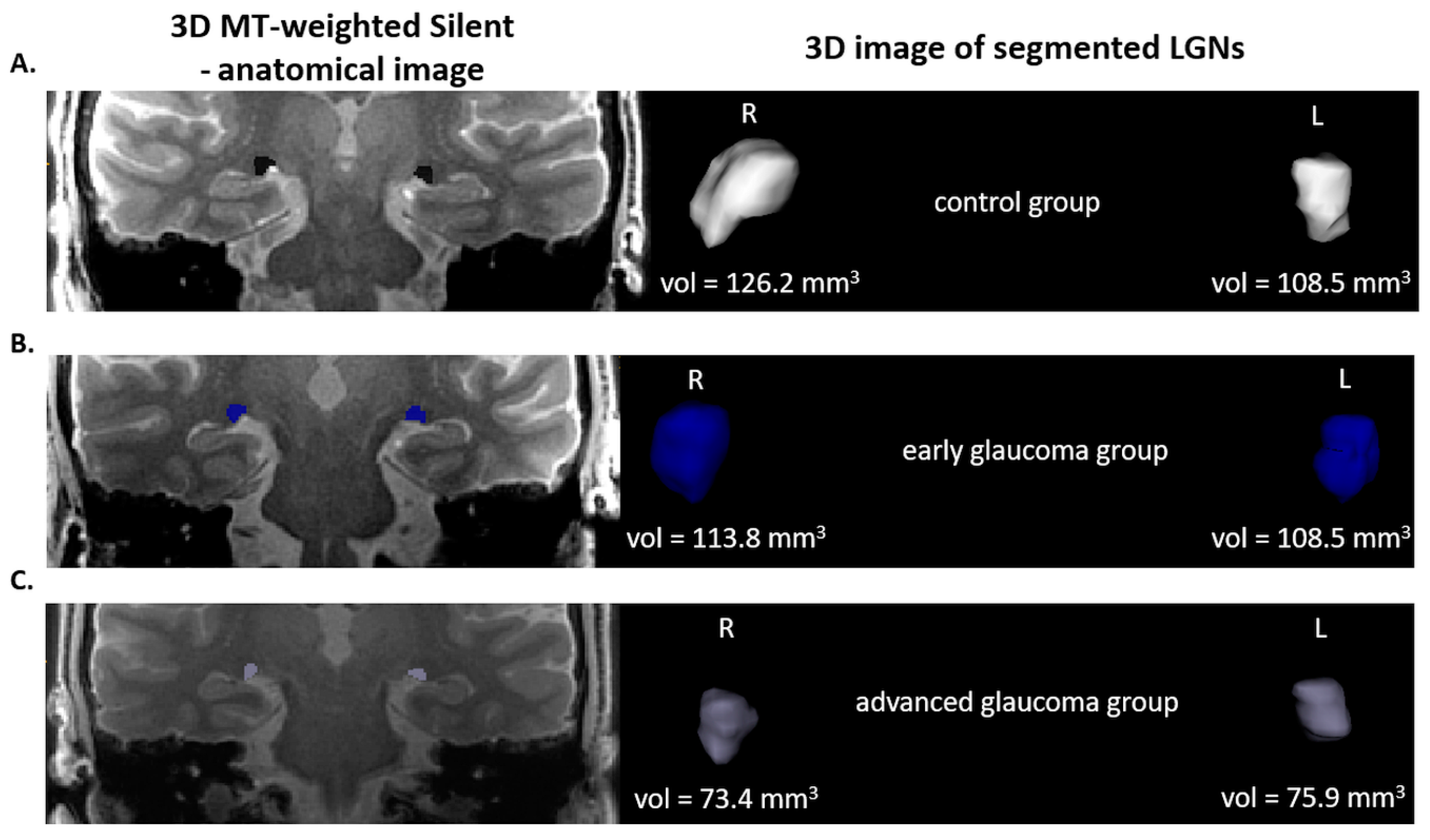 Medial Geniculate Nucleus Mri