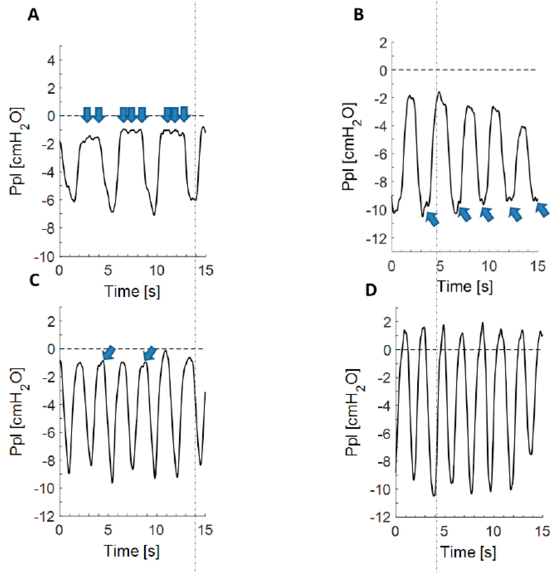 JCM | Free Full-Text | Pleural Pressure Pulse in Patients with Pleural ...