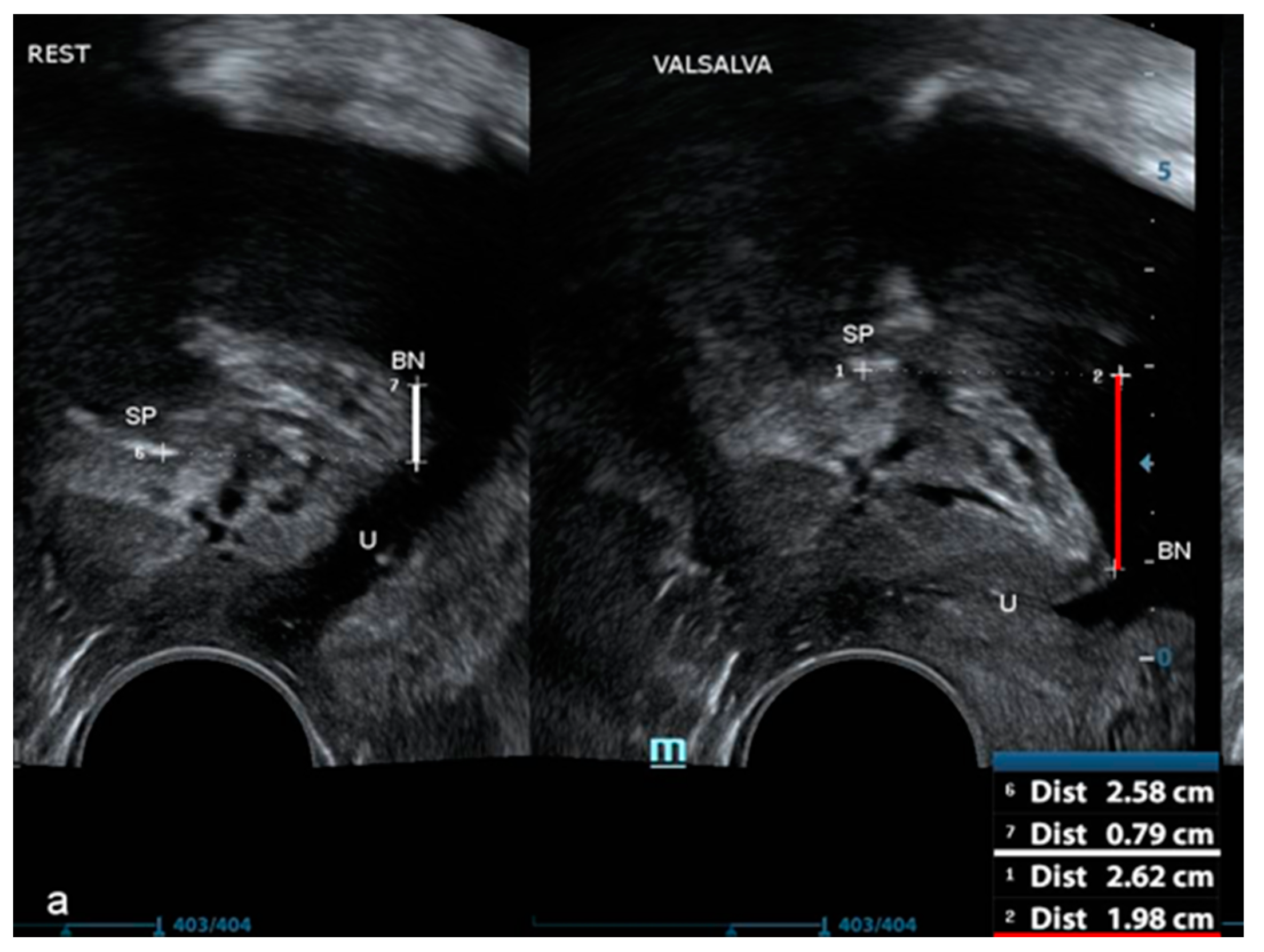 Jcm Free Full Text Epidemiological Features Of The Bladder Neck