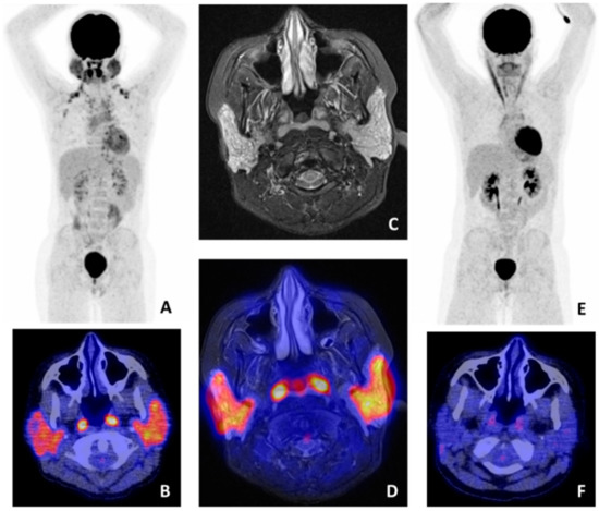 Imaging in Primary Sjögren’s Syndrome