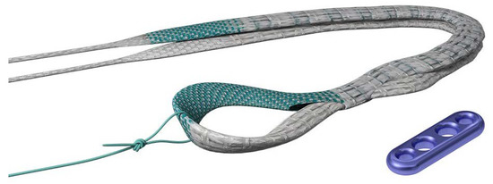 The Infinity-Lock System for Chronic Grade III AC Joint Dislocation: A ...