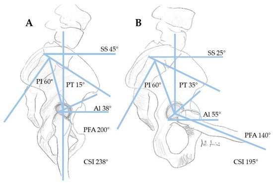 The Impact of Spinopelvic Mobility on Arthroplasty: Implications for ...