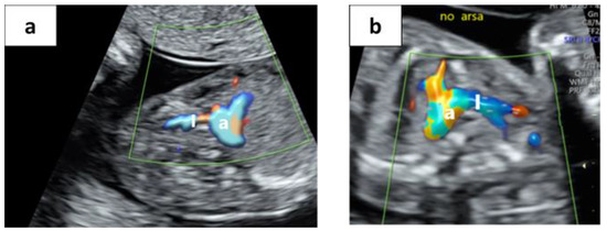 The “No ARSA” Sign: A Novel Method of Prenatal Screening for Aberrant ...