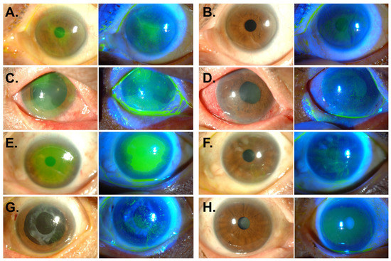 Corneal Epithelial Toxicity after Intravitreal Methotrexate Injection ...