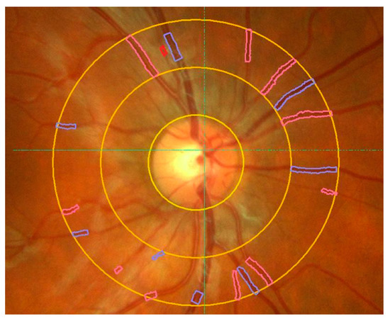 Retinal Neurovascular Coupling in Diabetes