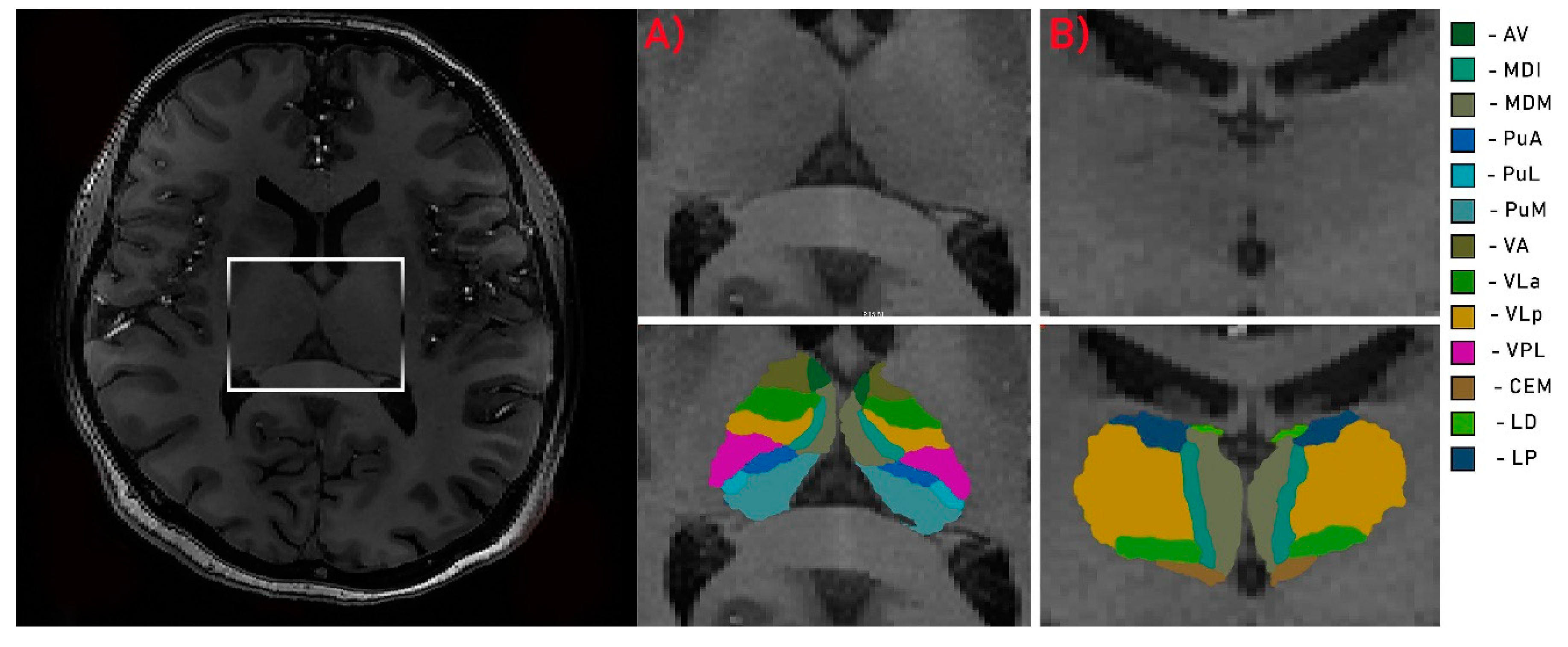 Medial Geniculate Nucleus Mri