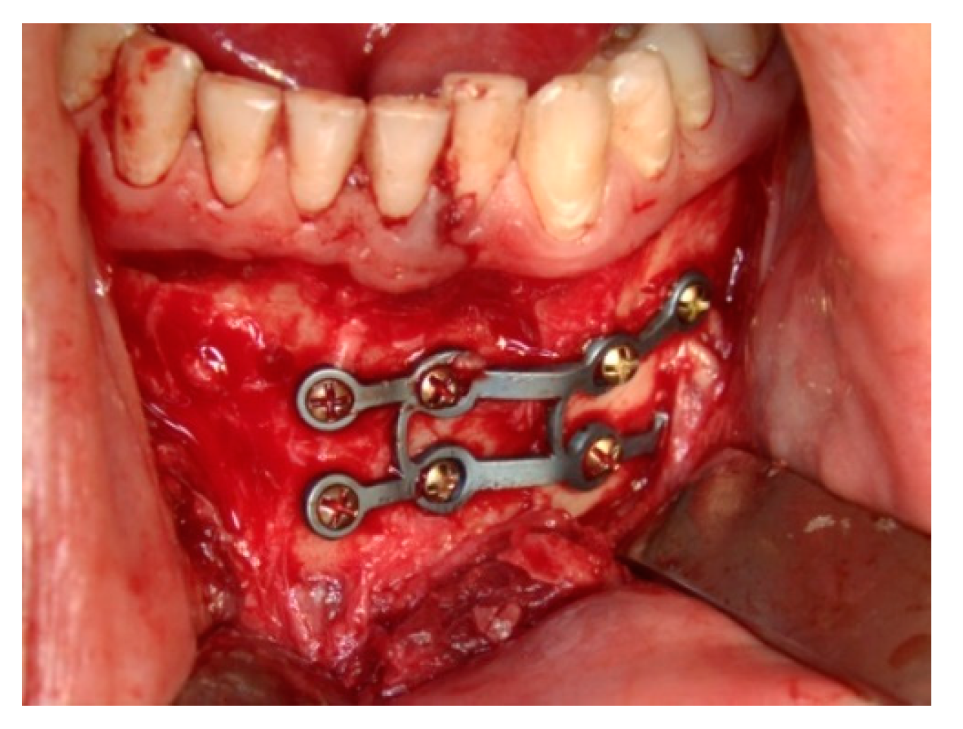 Treatment of Mandible Fractures Using a Miniplate System: A ...