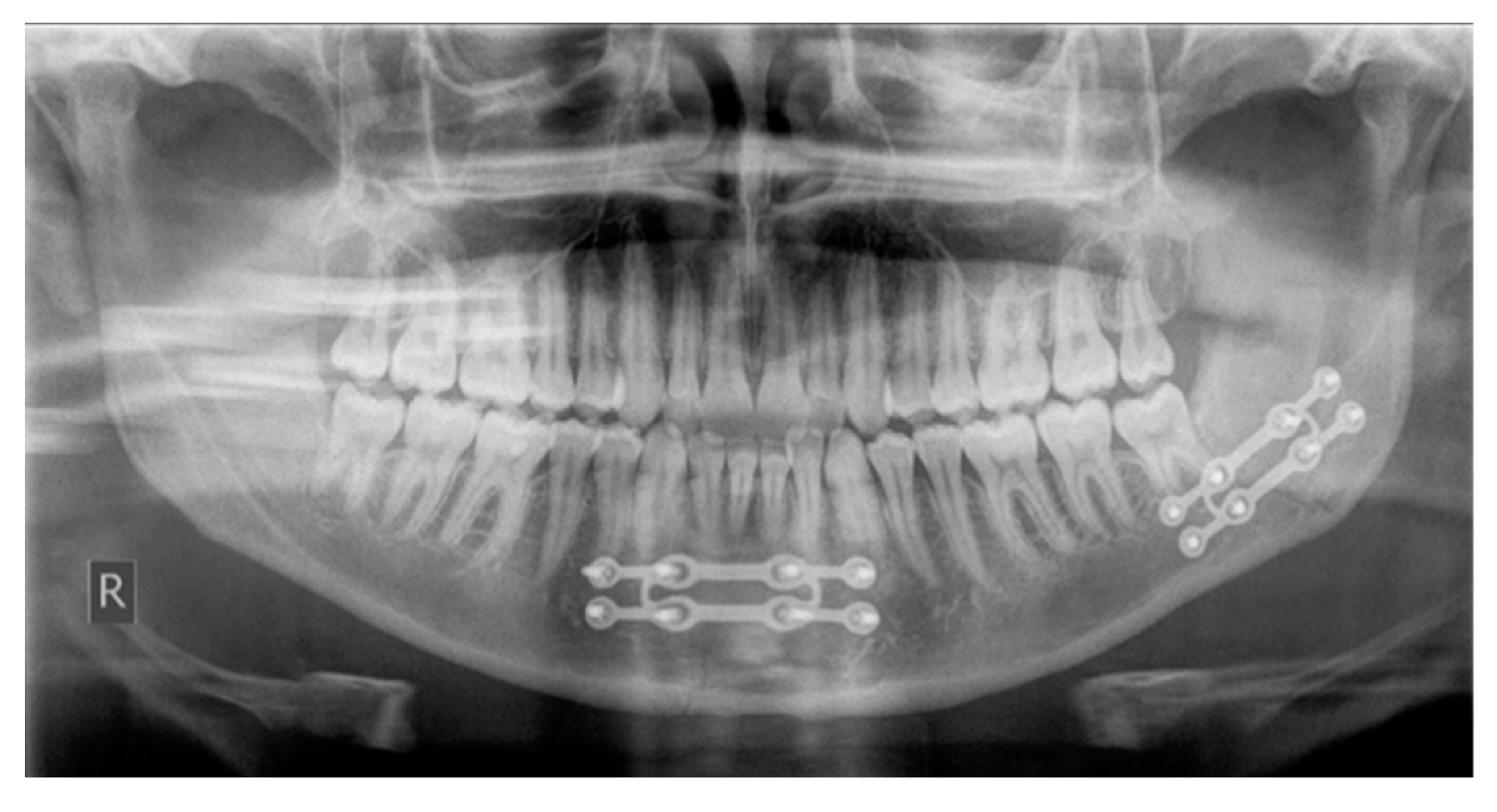 Treatment of Mandible Fractures Using a Miniplate System: A ...