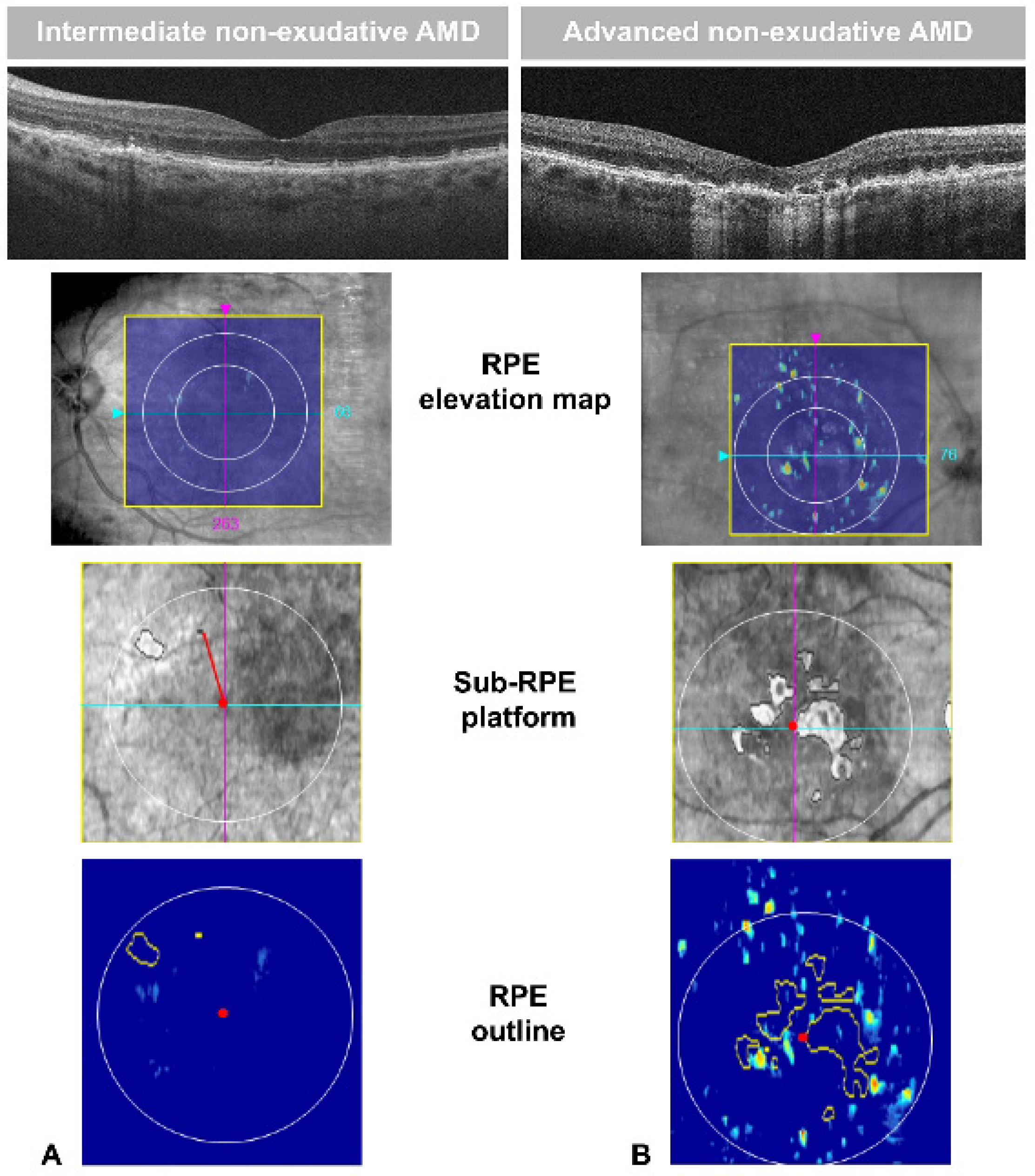 Retinal Pigment Epithelial and Outer Retinal Atrophy in Age-Related ...