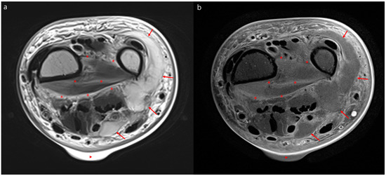 Utility of Magnetic Resonance Imaging for Differentiating Necrotizing ...