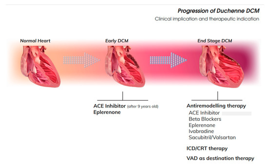 Duchenne Dilated Cardiomyopathy: Cardiac Management from Prevention to ...