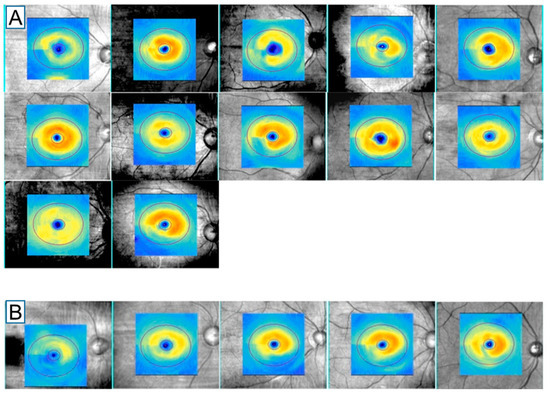 Using the Thickness Map from Macular Ganglion Cell Analysis to ...