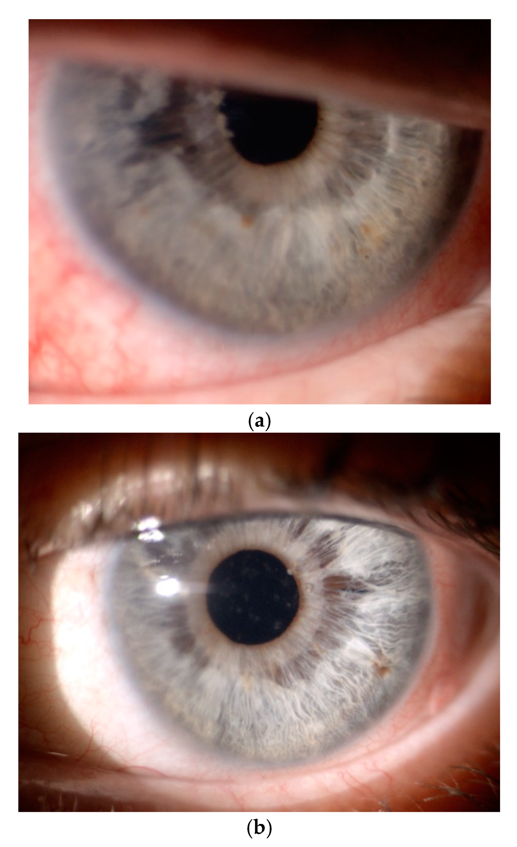 Iridoschisis—A Systematic Review