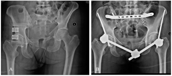 Radiostereometric Analysis Allows Assessment of the Stability and ...