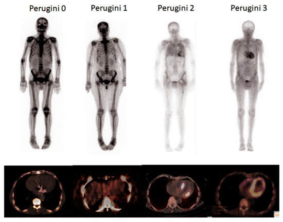 In Vivo Quantification of Myocardial Amyloid Deposits in Patients with ...