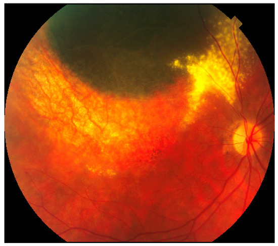 Chorioretinal Side Effects of Therapeutic Ocular Irradiation: A ...