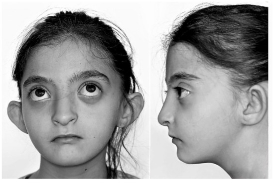 Oral Manifestations of Wolf-Hirschhorn Syndrome: Genotype-Phenotype ...