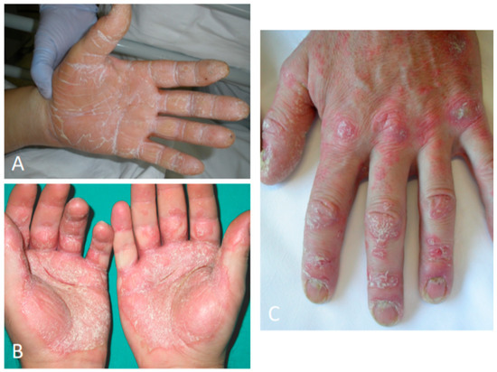 Topographic Differential Diagnosis of Chronic Plaque Psoriasis ...