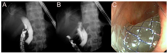 Which Are the Most Suitable Stents for Interventional Endoscopic ...