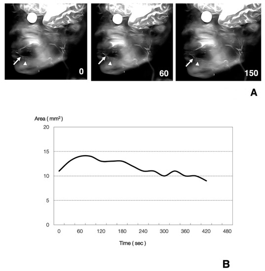 First Report of Sublingual Gland Ducts: Visualization by Dynamic MR ...
