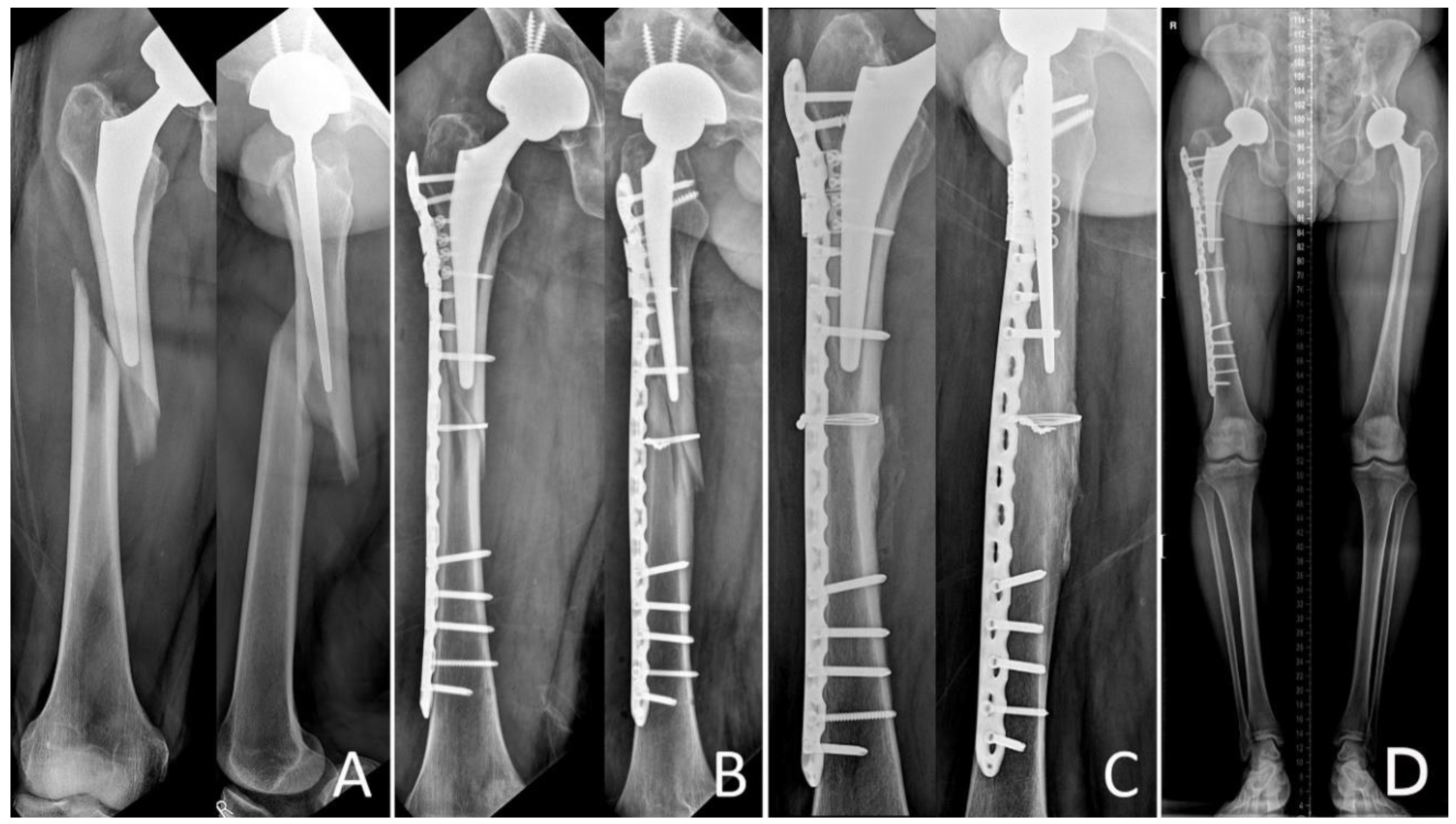 High Failure Rates of Locking Compression Plate Osteosynthesis with ...