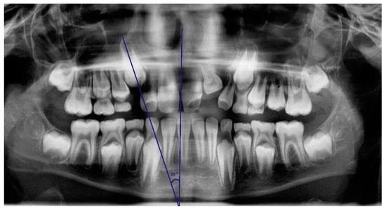 Frequency of Additional Congenital Dental Anomalies in Children with ...