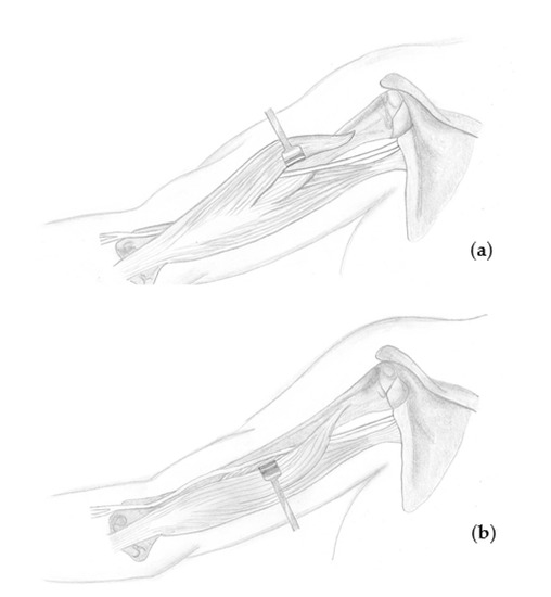 Management of Radial Nerve Lesions after Trauma or Iatrogenic Nerve ...