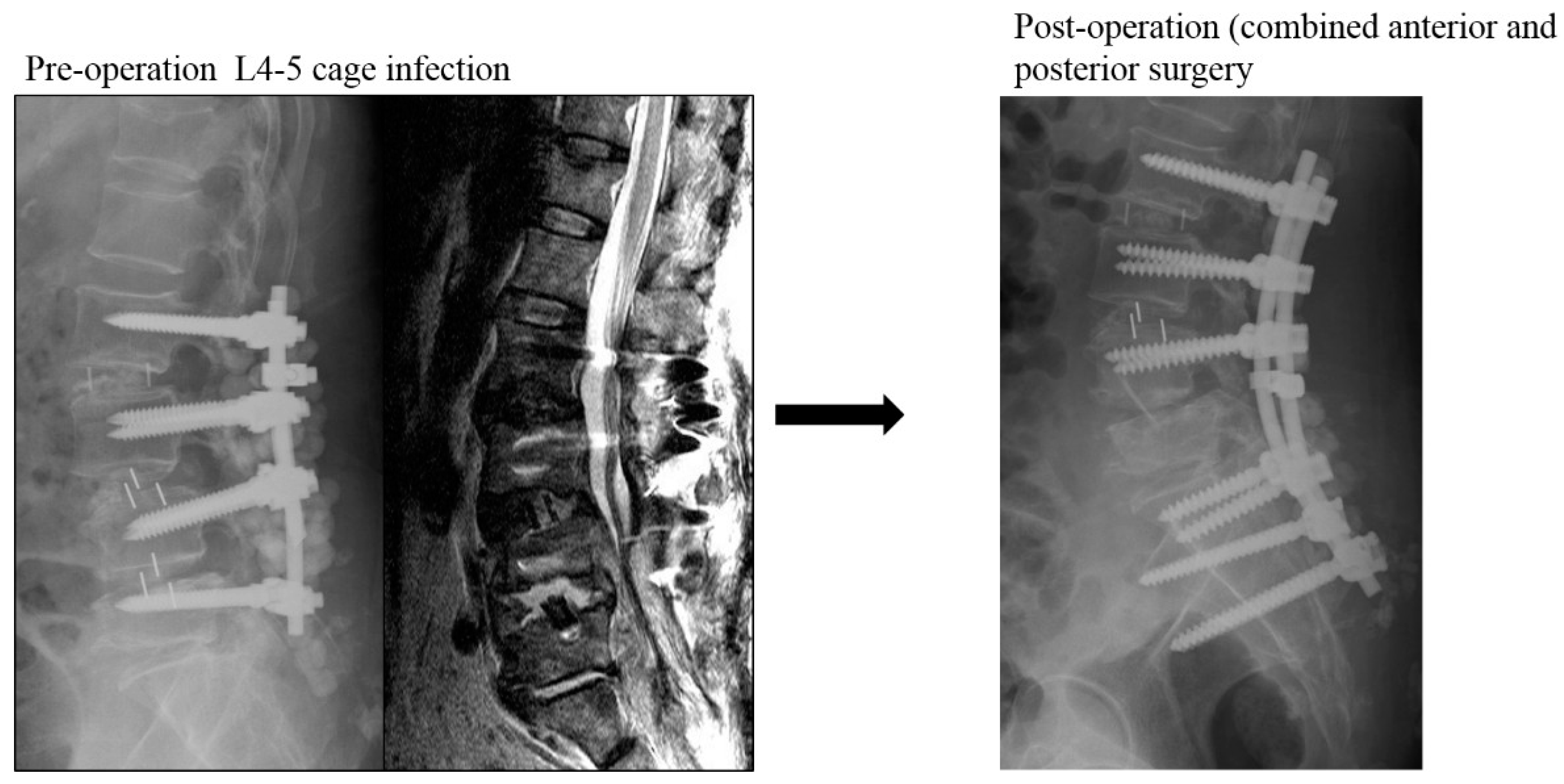 Revision Surgery for Postoperative Spondylodiscitis at Cage Level after ...