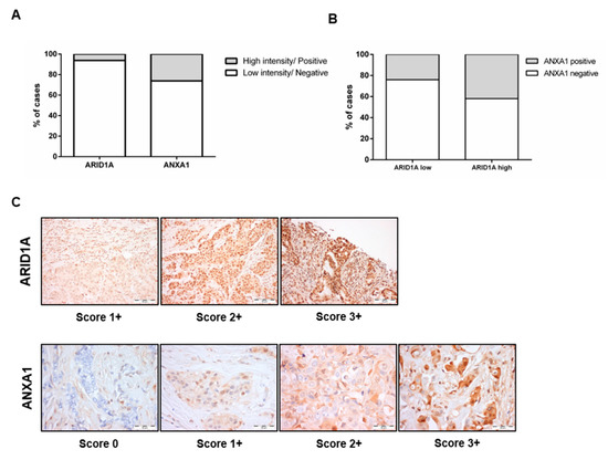 Clinical Significance of ARID1A and ANXA1 in HER-2 Positive Breast Cancer