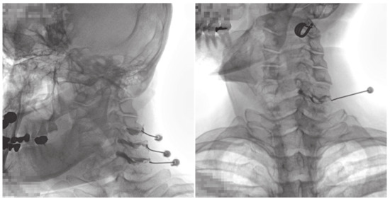 Fluoroscopic Findings of Extra-Cervical Facet Joint Flow and Its ...