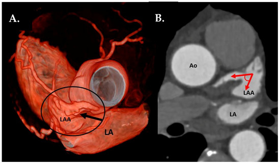 JCM | Free Full-Text | Left Atrial Appendage Morphology and Left Atrial ...