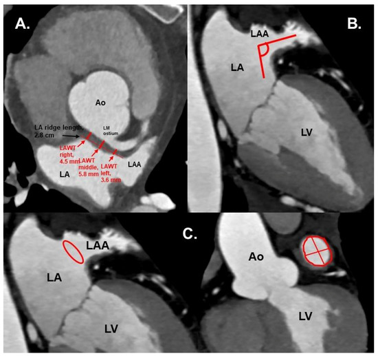JCM | Free Full-Text | Left Atrial Appendage Morphology and Left Atrial ...