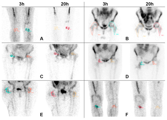 Handling of Doubtful WBC Scintigraphies in Patients with Suspected ...