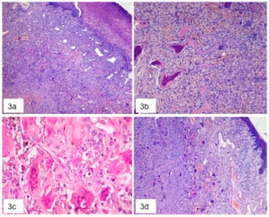 Central Giant Cell Granuloma Histology