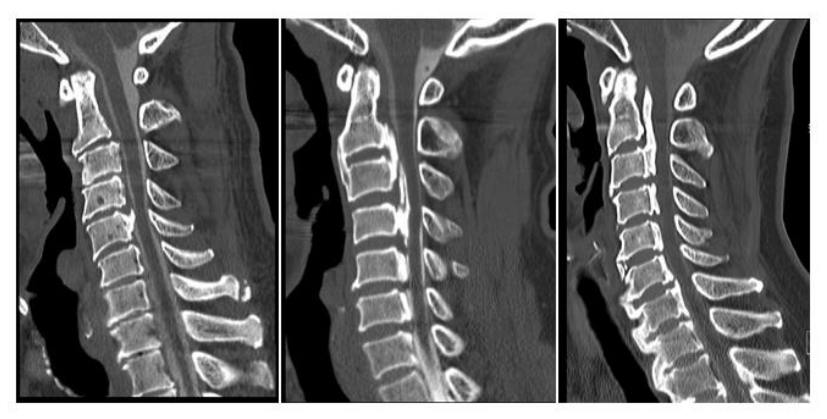 Ossification Posterior Longitudinal Ligament Spine Or