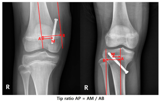 JCM | Free Full-Text | Affecting Factors and Correction Ratio in Genu ...