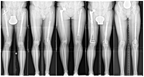 Intramedullary Bone Lengthening Following Preceding Hip Surgery—A Case ...