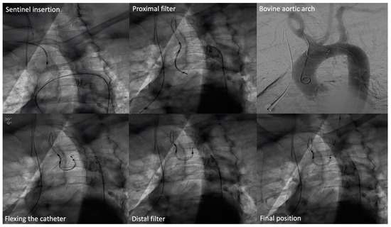 Feasibility and Safety of Cerebral Embolic Protection Device Insertion ...